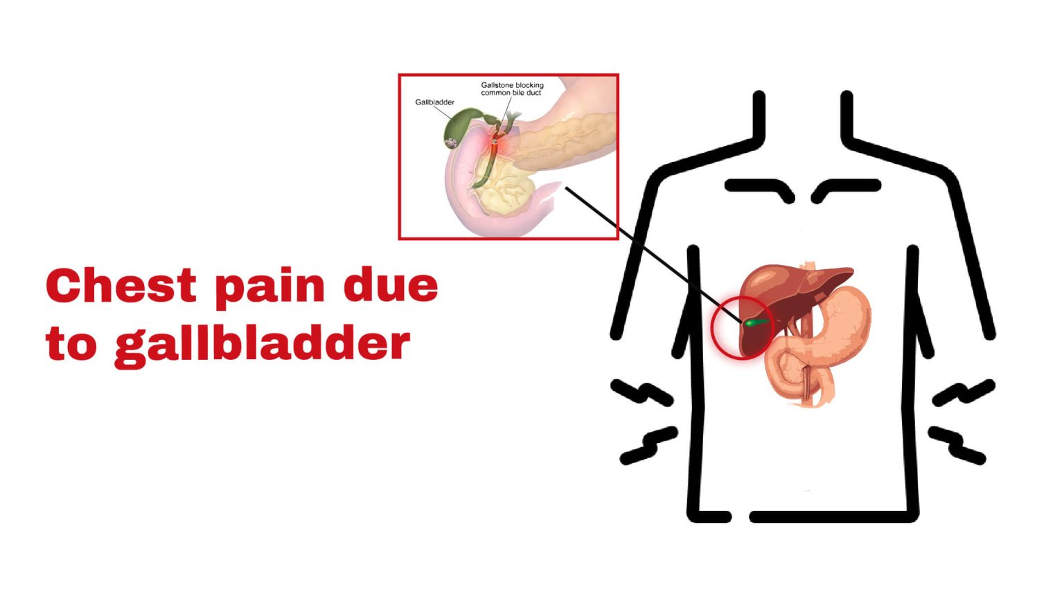 Chest Pain Due To Gallbladder Chest Pain