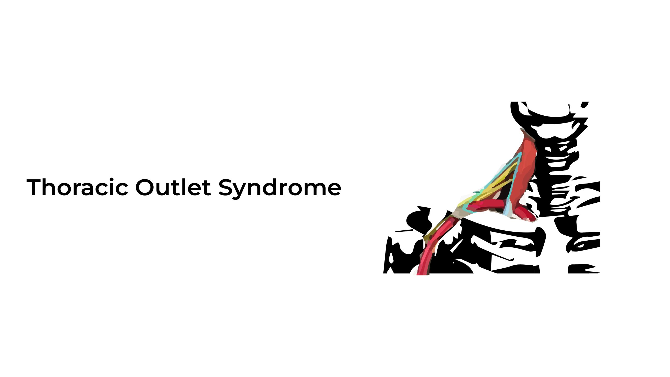 Thoracic Outlet Syndrome ~ Chest Pain